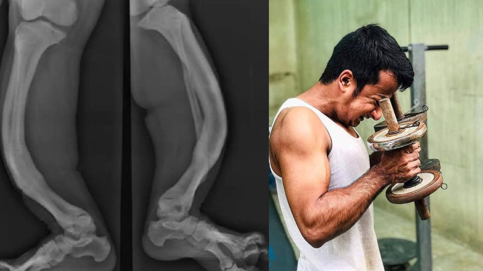 20 Years Old Pakistani ‘Superman’ Beats Genetically Bone Disorder